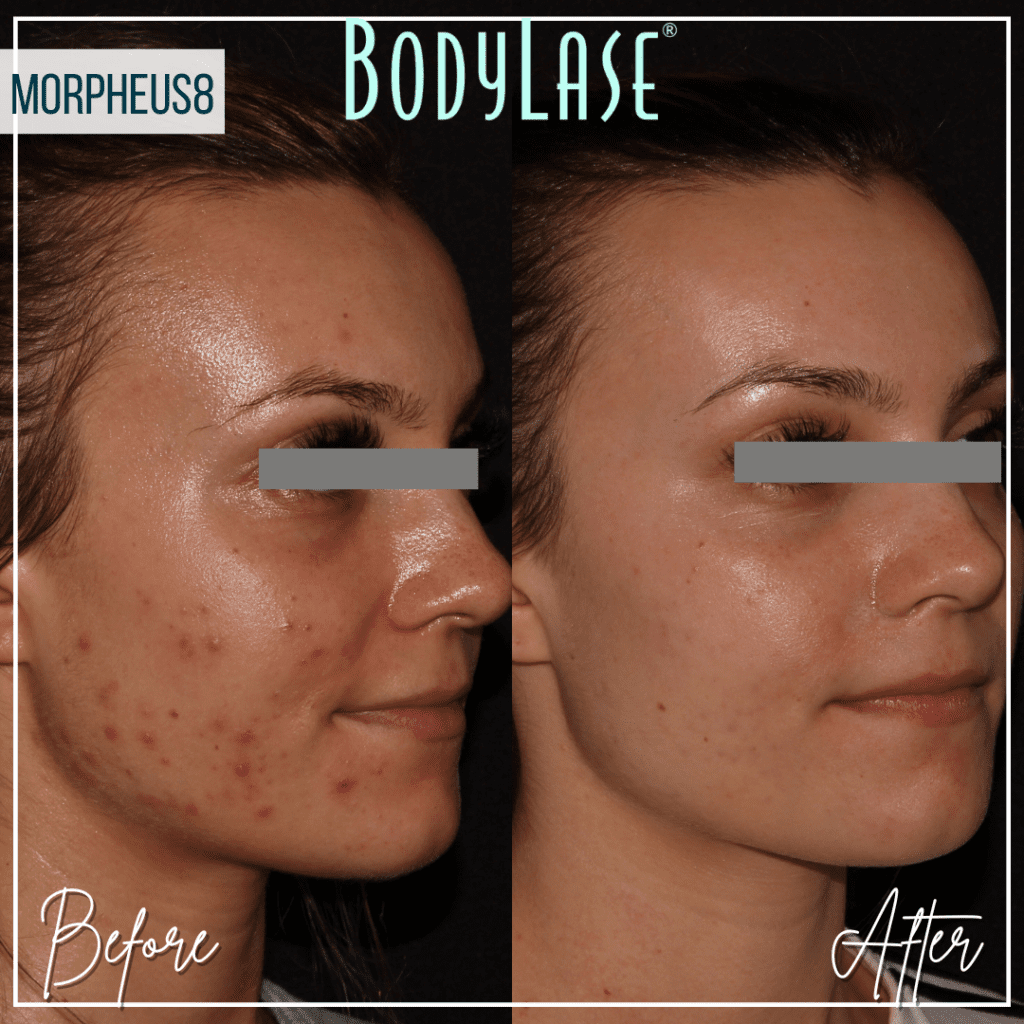 Morpheus8 BodyLase B&A 3