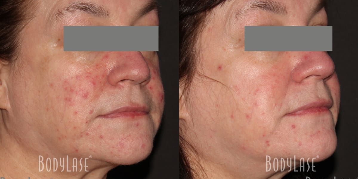 2D/3D/4D Facial | BodyLase®