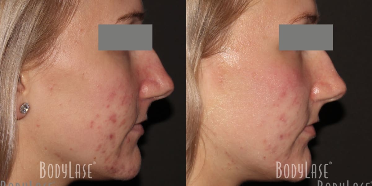 2D/3D/4D Facial | BodyLase®