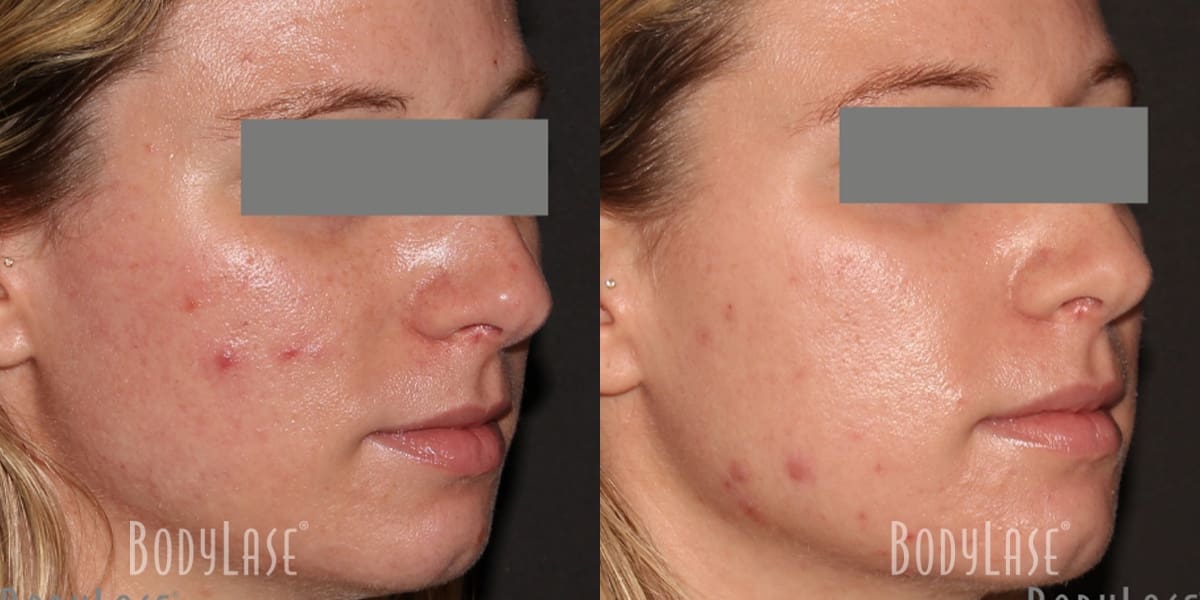 2D/3D/4D Facial | BodyLase®