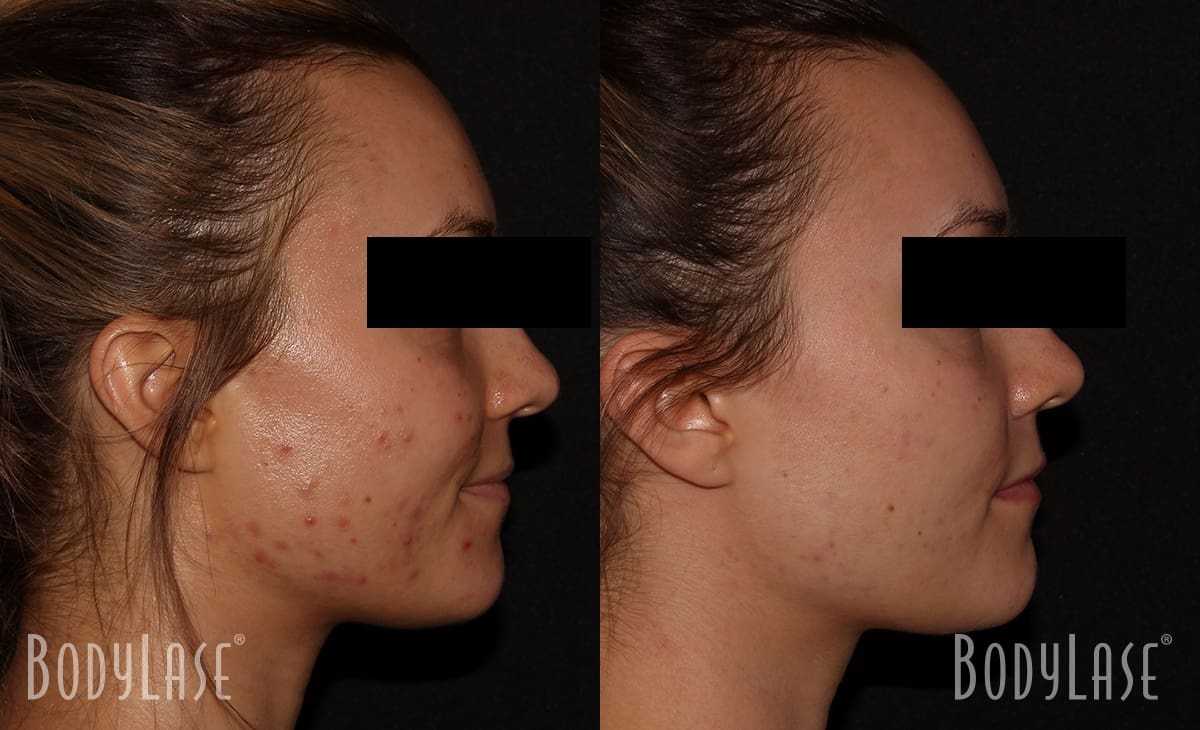 Morpheus8 | BodyLase® | Raleigh, NC & Cary, NC